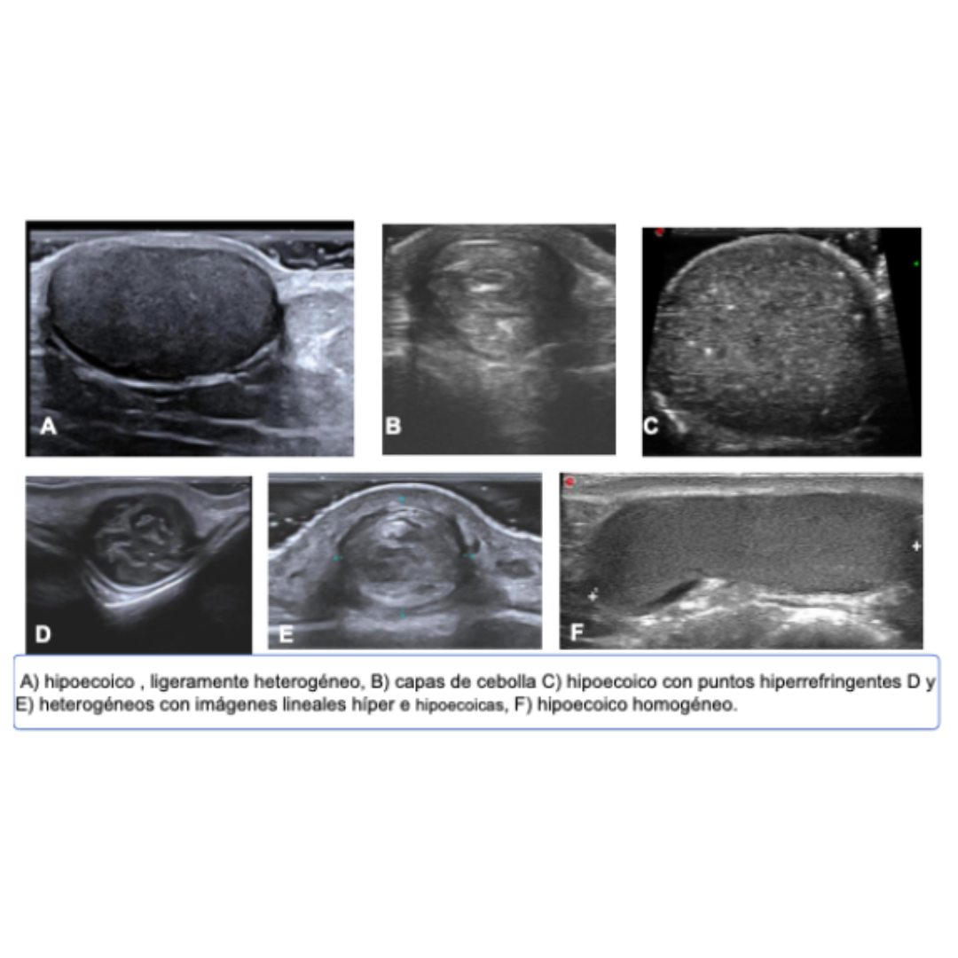 Quiste de Inclusión Epidérmico y sus Características Ecográficas ...