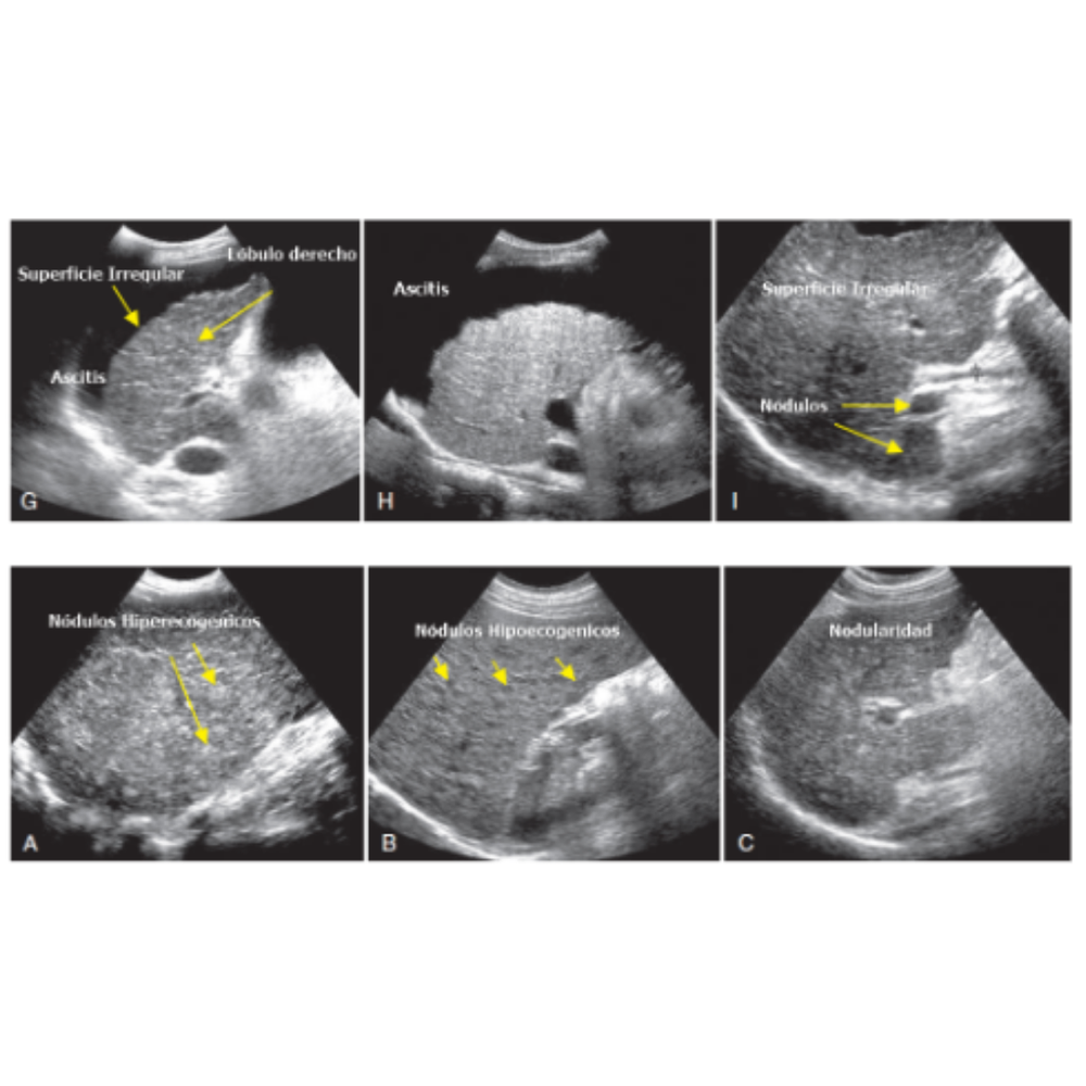 Daño Hepático Crónico: Hallazgos Ecográficos Importantes en Hepatopatía ...