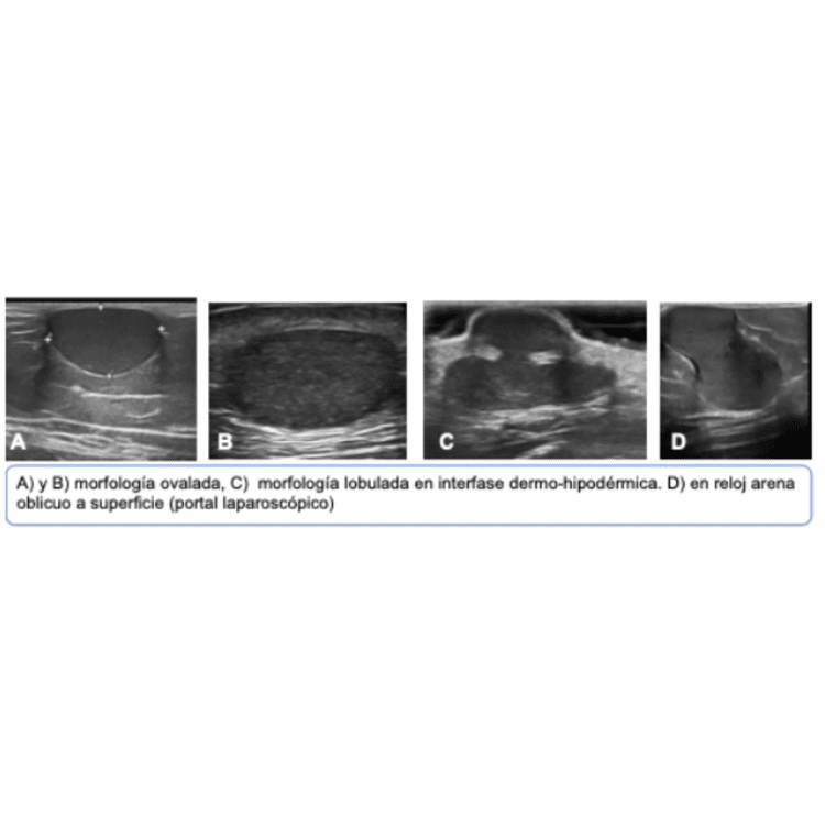 Quiste de Inclusión Epidérmico y sus Características Ecográficas ...