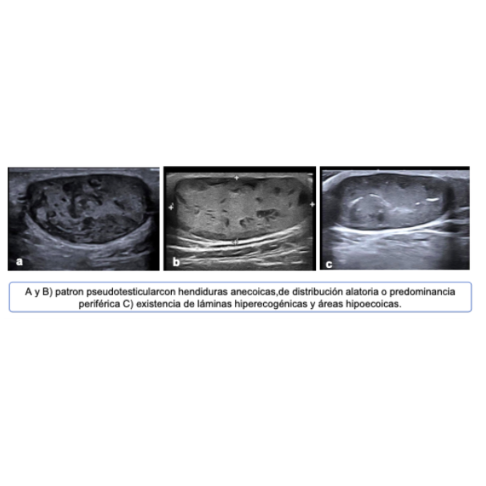 Quiste de Inclusión Epidérmico y sus Características Ecográficas ...
