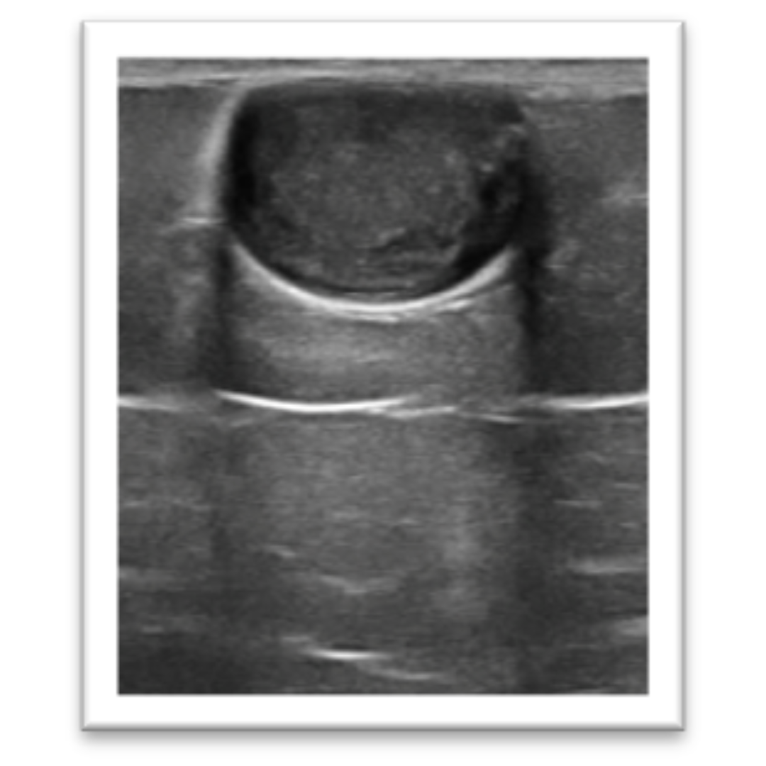 Quiste de Inclusión Epidérmico y sus Características Ecográficas ...