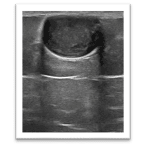 Quiste de Inclusión Epidérmico y sus Características Ecográficas ...