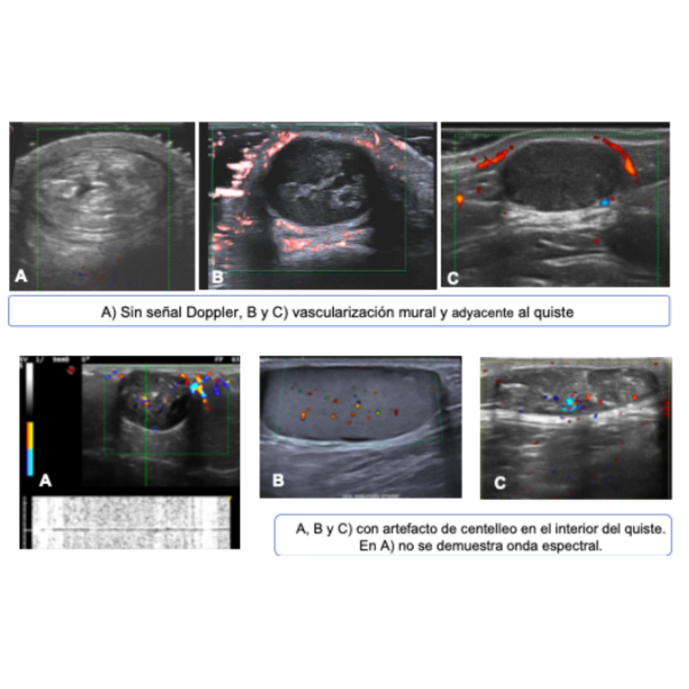 Quiste de Inclusión Epidérmico y sus Características Ecográficas ...