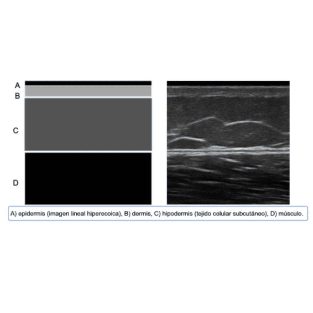 Quiste de Inclusión Epidérmico y sus Características Ecográficas ...