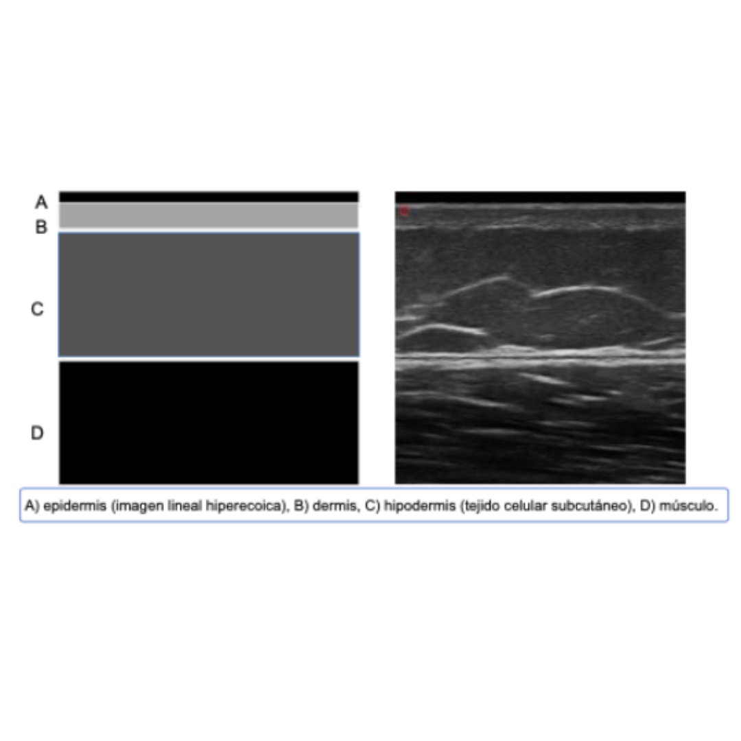 Quiste de Inclusión Epidérmico y sus Características Ecográficas ...