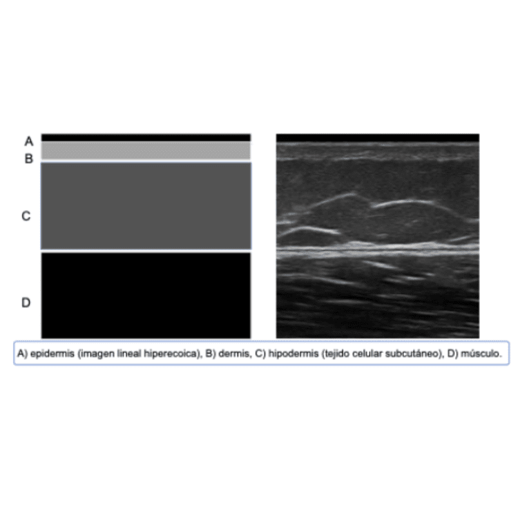 Quiste de Inclusión Epidérmico y sus Características Ecográficas ...
