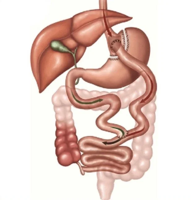 Weight Loss Surgery — Louisiana Center for Bariatrics at Baton Rouge ...