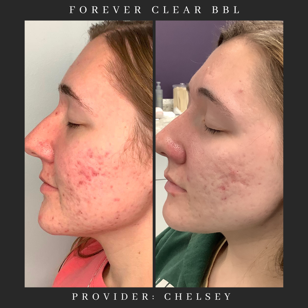 Forever Clear— Inspirations Med Spa -Portage, MI Skincare and Wellness Experts