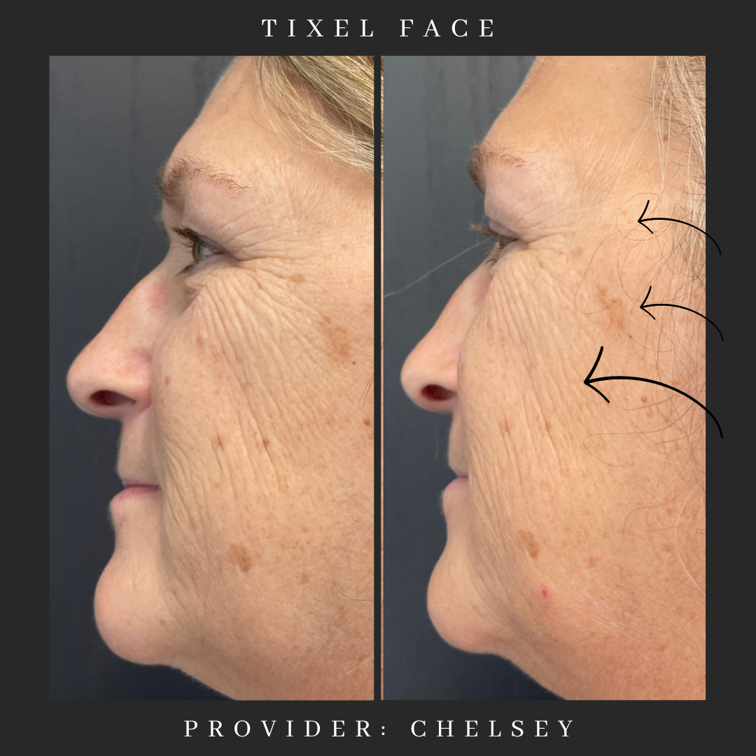 Tixel Treatment in Portage, MI | Inspirations Med Spa— Inspirations Med ...