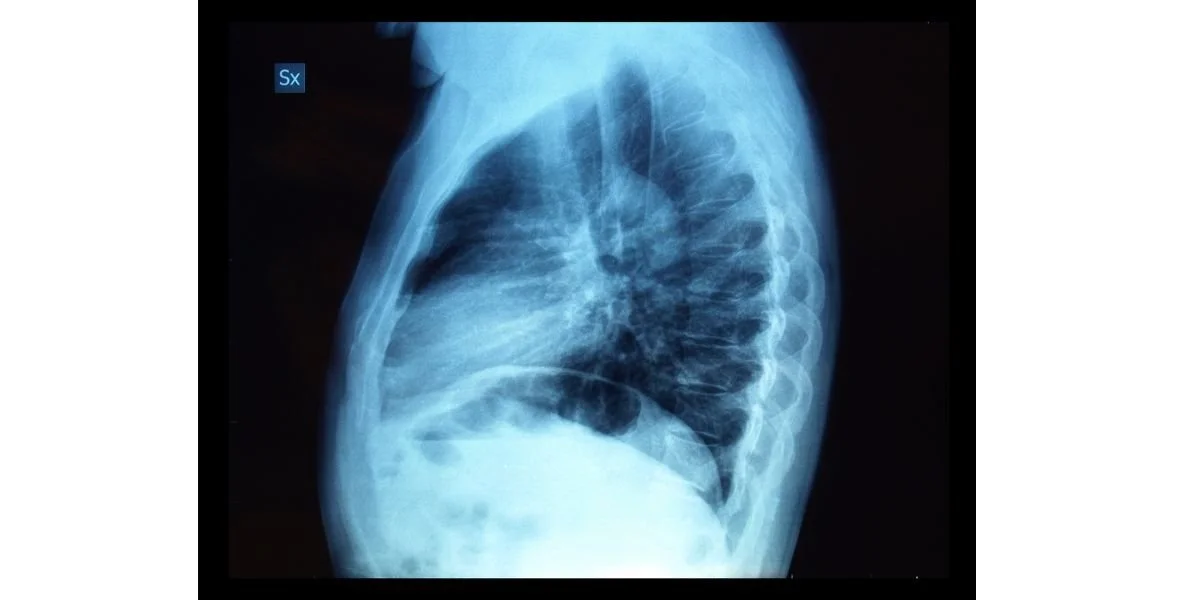 What Is Kyphosis - Symptoms, Causes, and Treatment Options — Bergin Motion