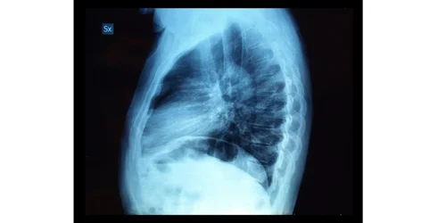 What Is Kyphosis - Symptoms, Causes, and Treatment Options — Bergin Motion