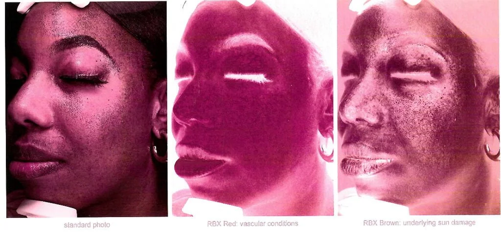 VISIA Skin Analysis — Wallace Skin & Body Institute