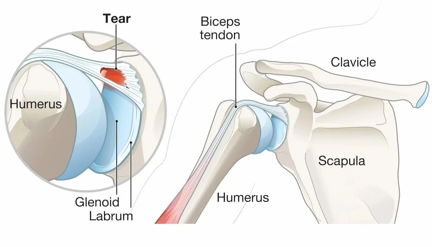 Posterior Labral Tear | Beacon Orthopaedics