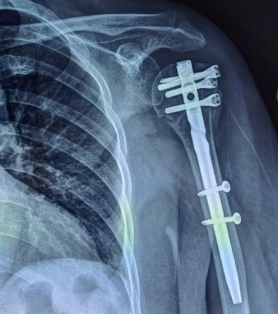 Shoulder Fractures Specialist | Beacon Orthopaedics