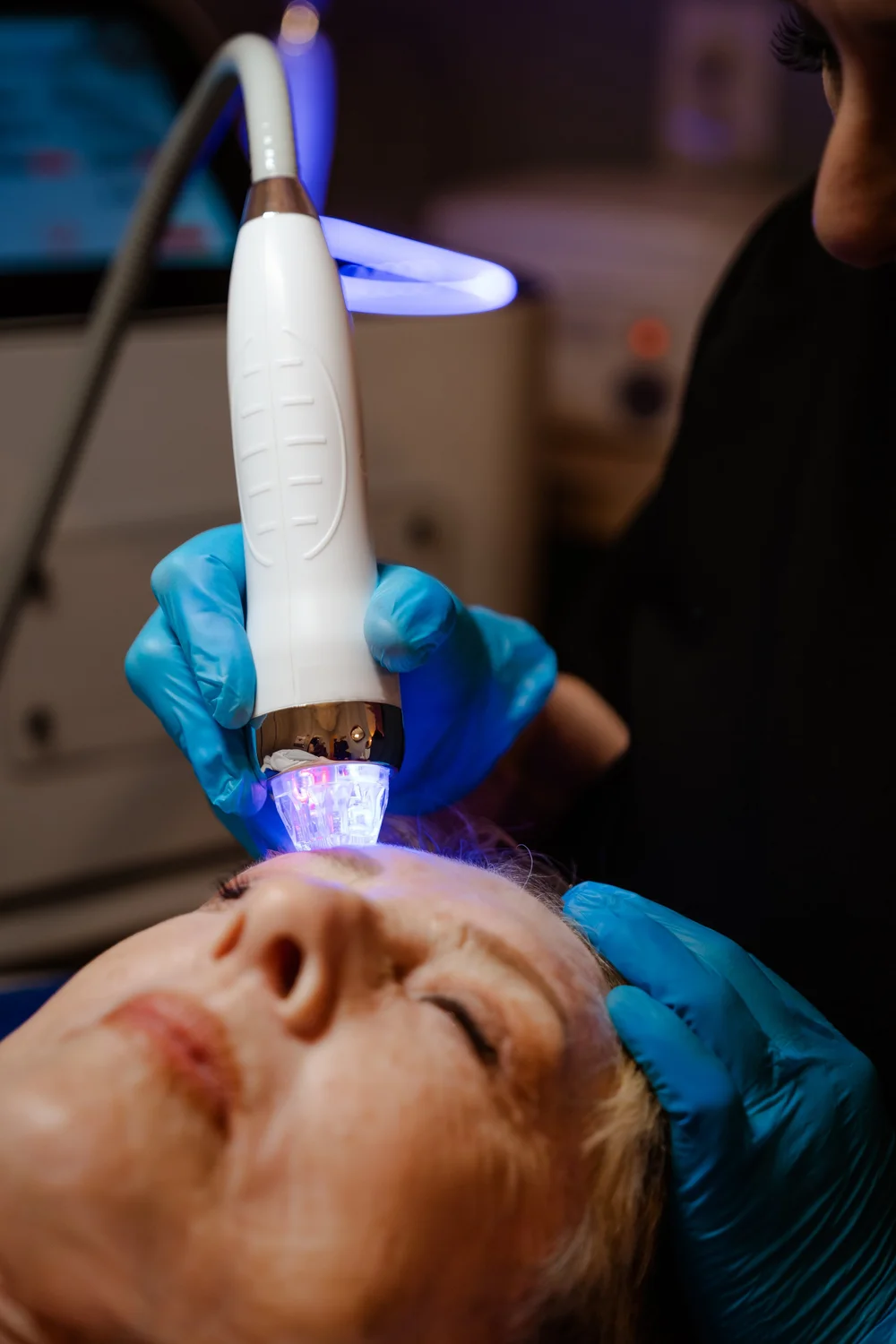 Microneedling — SPA BLEU