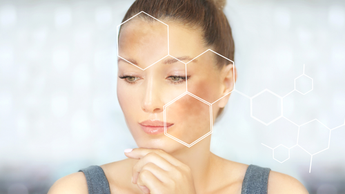 The Truth About Melasma: Everything You Need to Know — SPALINA SKIN CARE