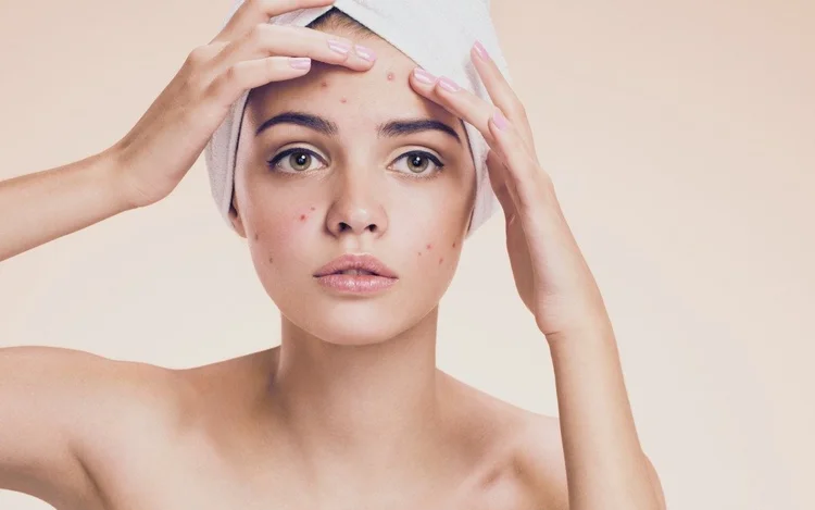 How to Treat A Popped Pimple — SPALINA SKINCARE