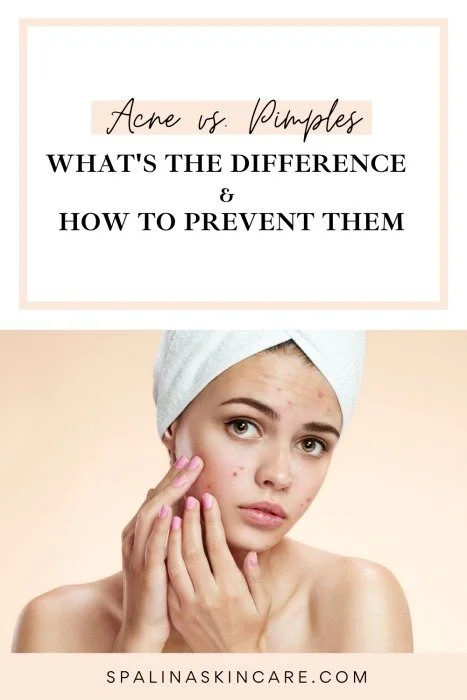 Acne vs. Pimples: What’s the Difference and How to Prevent Them ...