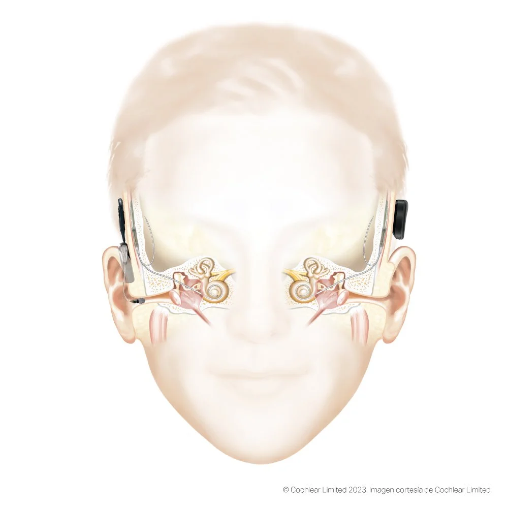 Más sobre implantes cocleares — seroido
