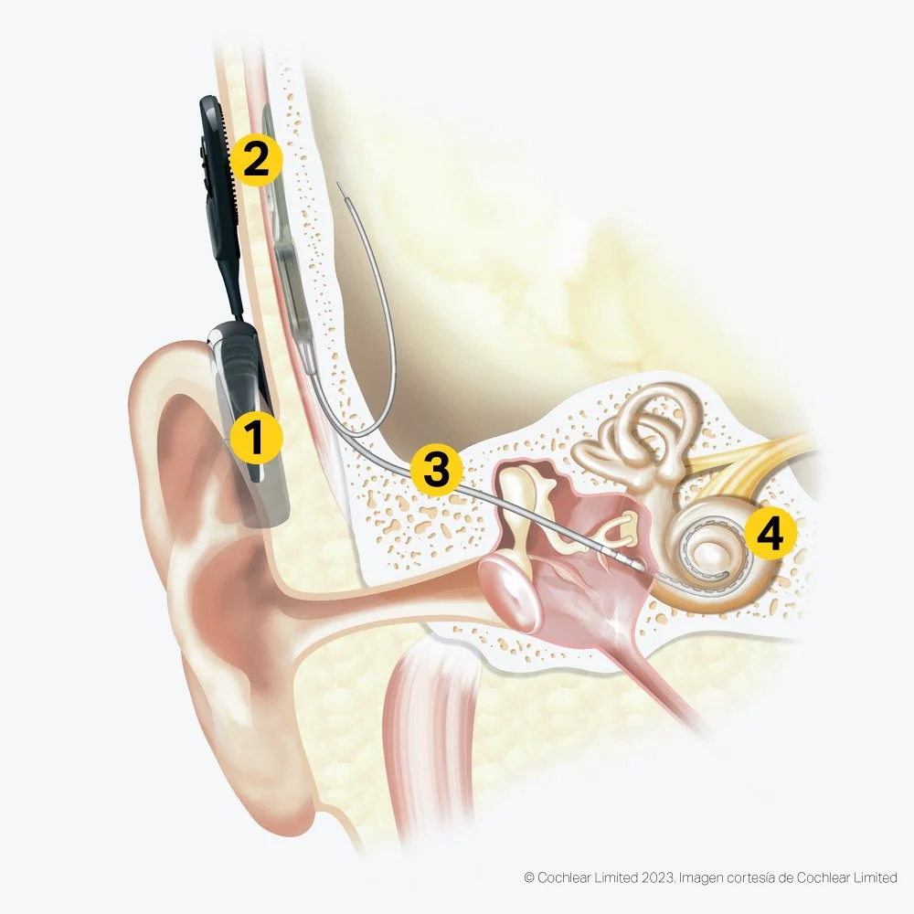Más sobre implantes cocleares — seroido