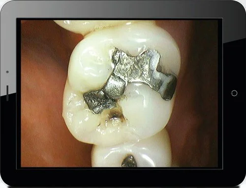 LED IC100 Intraoral Cameras | Tuxedo Imaging | Tuxedo Imaging