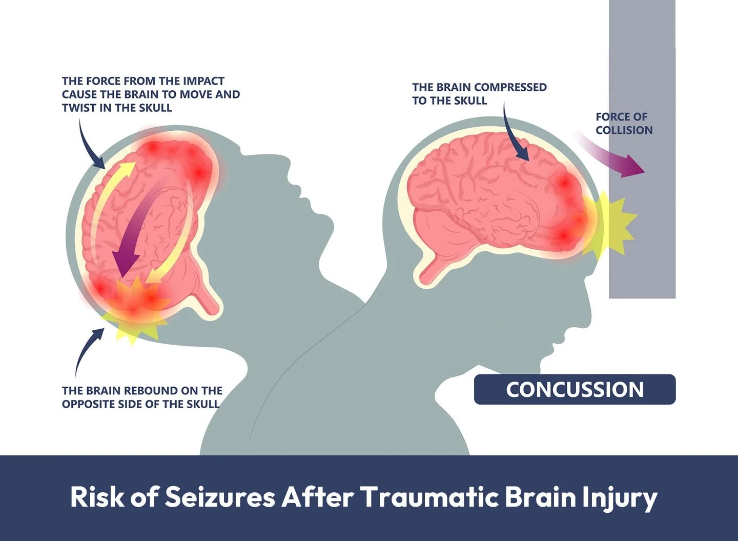Risk of Seizures After Traumatic Brain Injury — Concussion Spot Education
