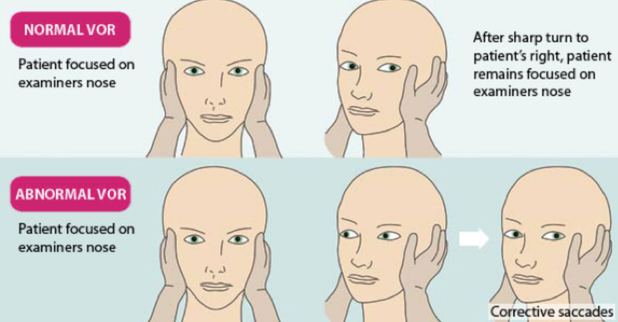 Acute Vestibular Syndrome: The Role of HINTS-Plus Exam