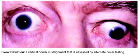 Acute Vestibular Syndrome: The Role of HINTS-Plus Exam