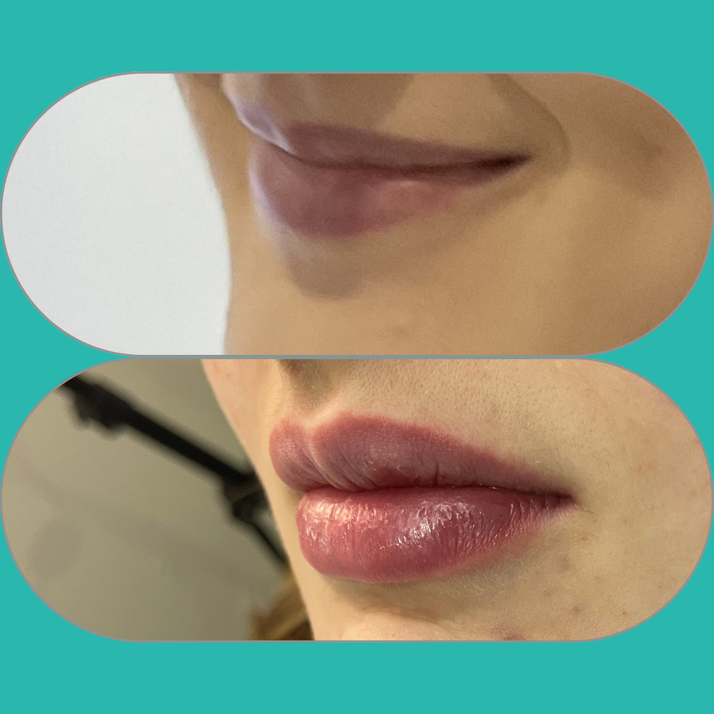 Dermal fillers in Tunbridge Wells? Find Out Now! — The Face Workshop®