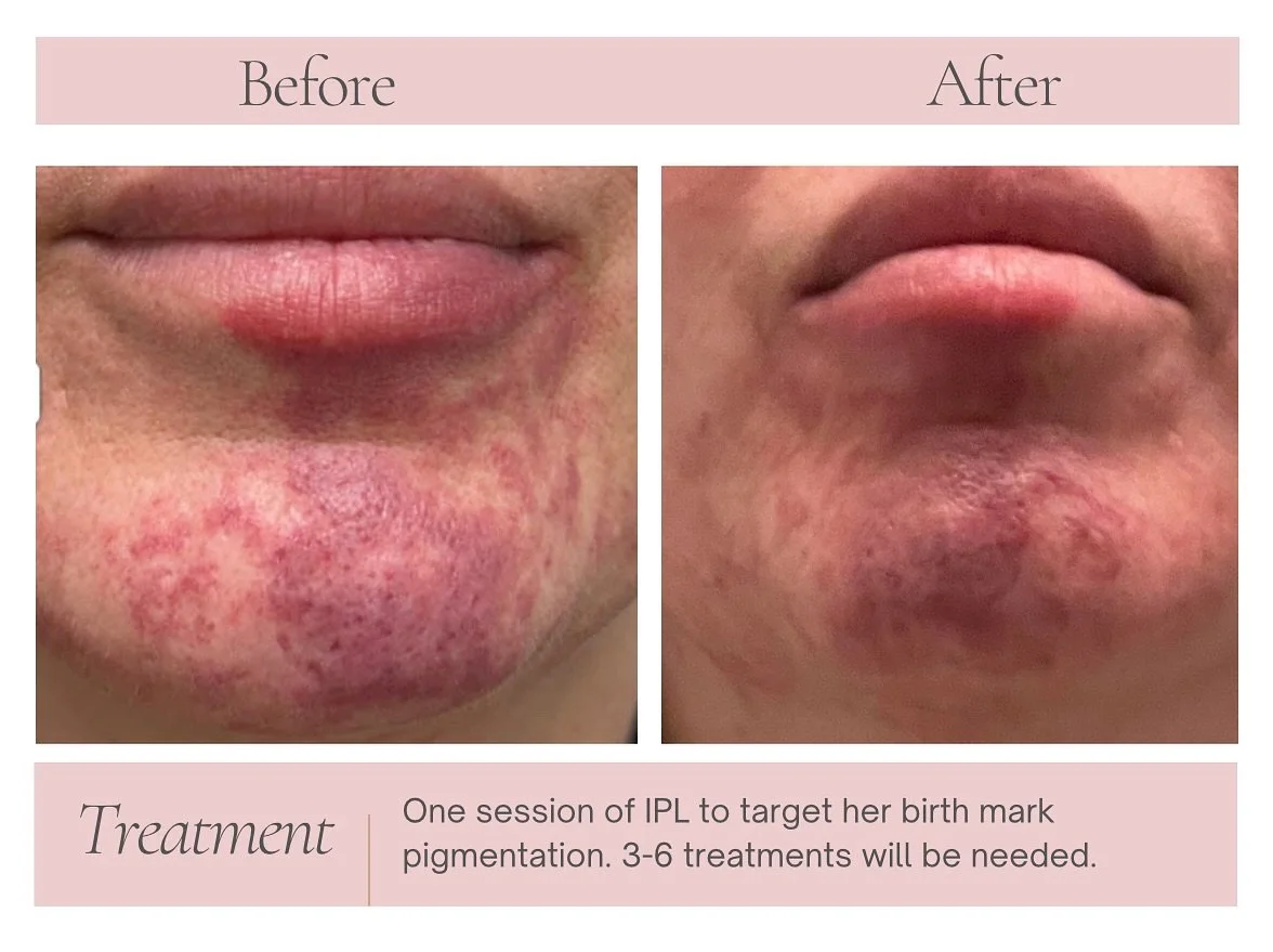 Laser Services — Liv Esthetics