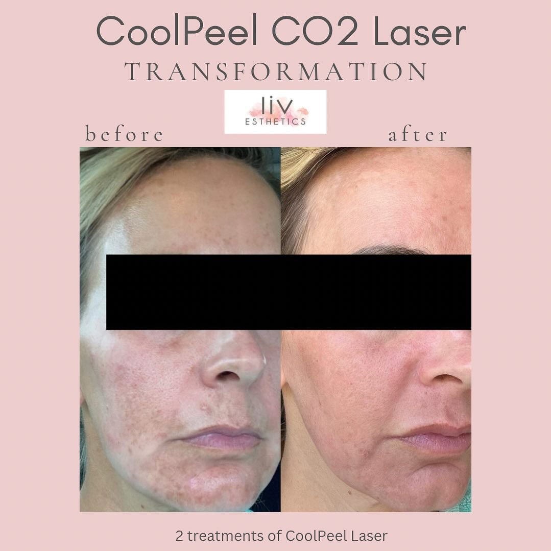 Laser Services — Liv Esthetics