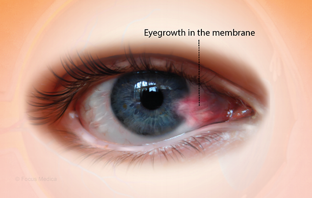 Pterygium Removal