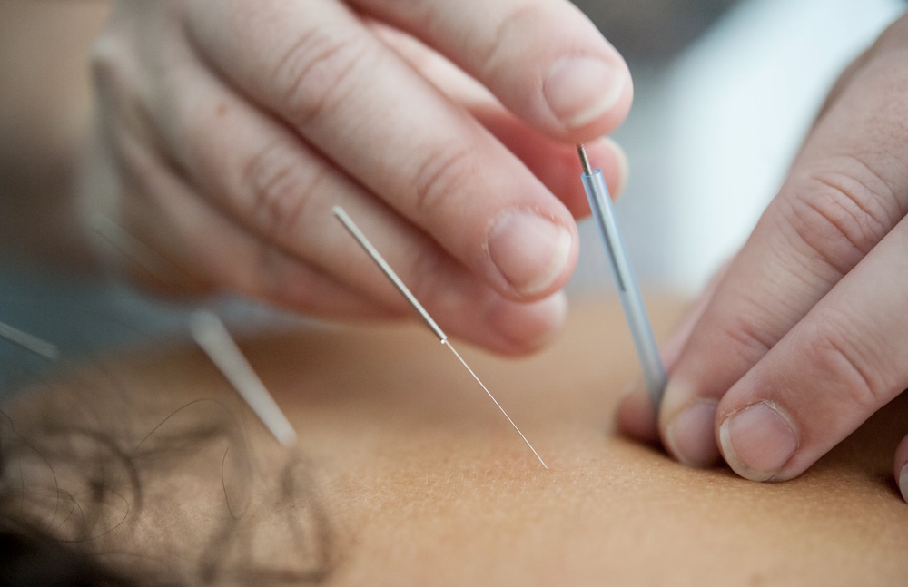 How Deep Do Acupuncture Needles Go? An In-Depth Look (2024) — Holistic ...