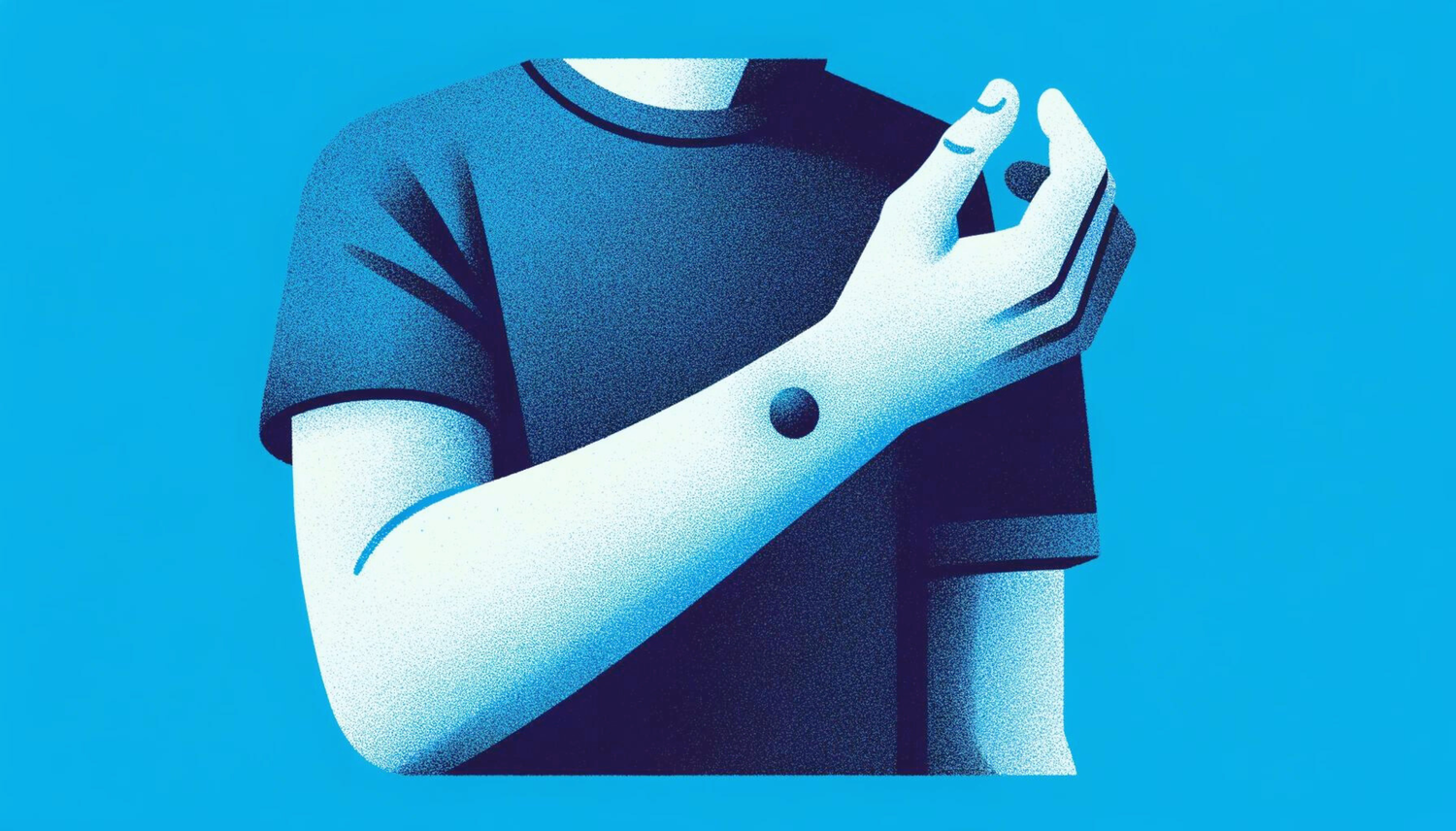 Bruising After Acupuncture: Everything You Need to Know (2024 ...