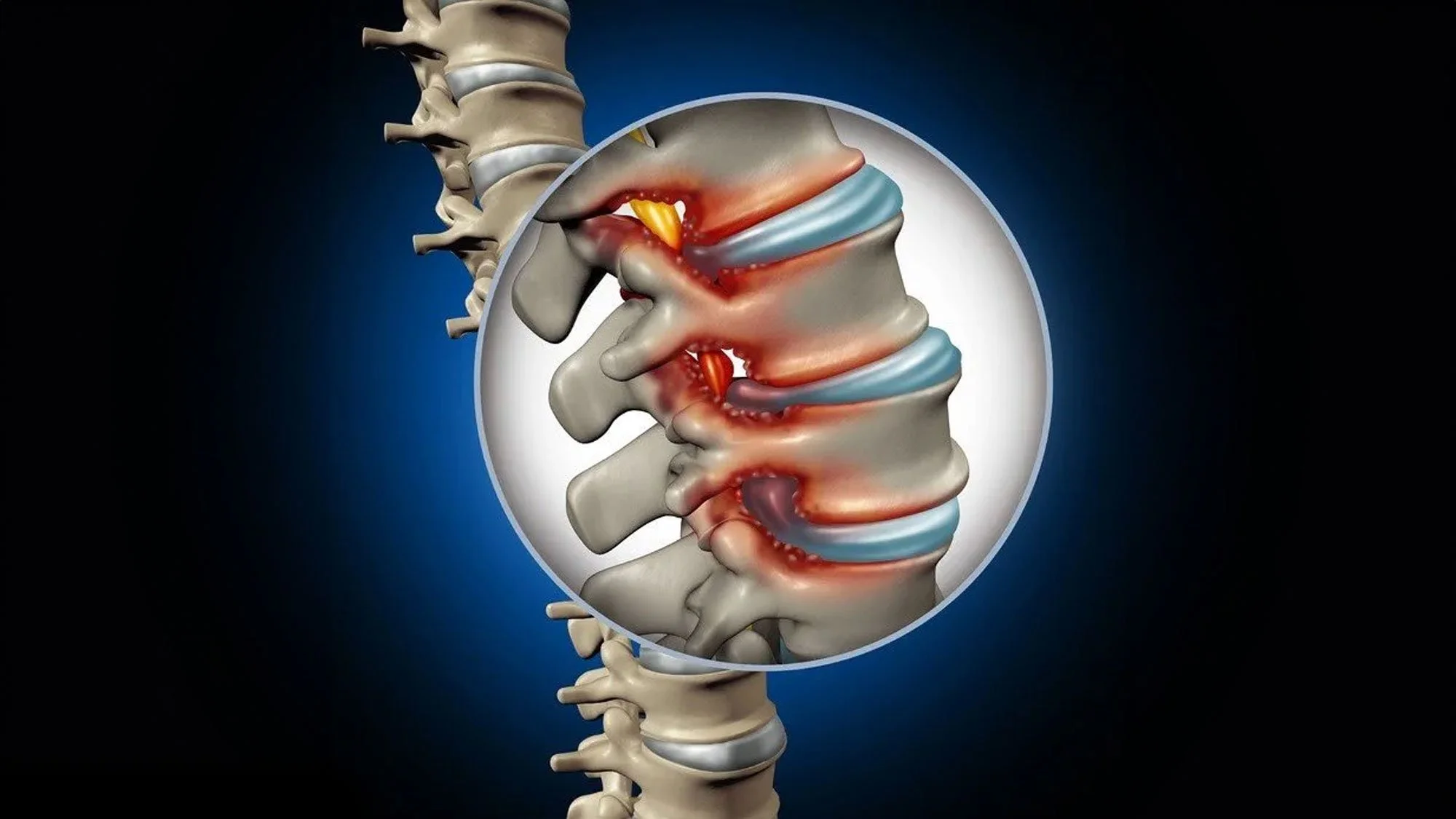 Can My Chiropractor Help My Spinal Stenosis? — Garden State Spinal Care