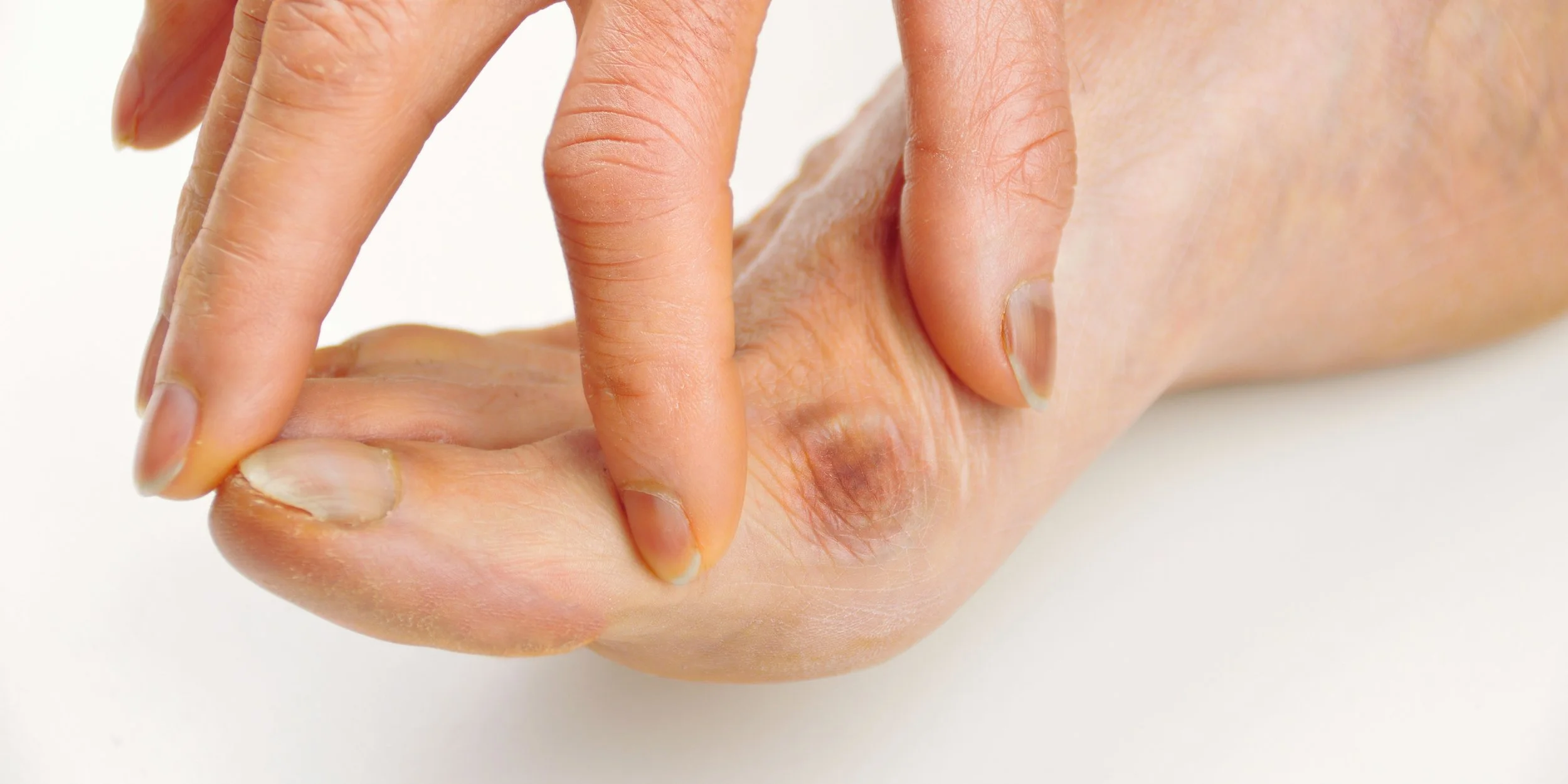 Stepping into Awareness: Recognizing and Addressing Foot Melanoma — Tea ...