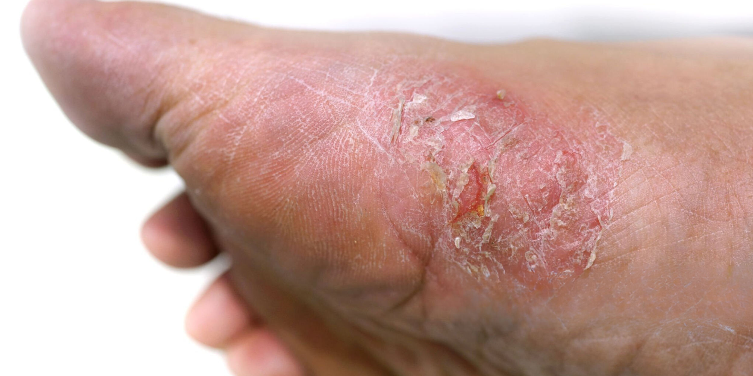 Soothe Your Soles: Uncovering the Causes and Treatment Options for Psoriasis on Feet — Tea ...