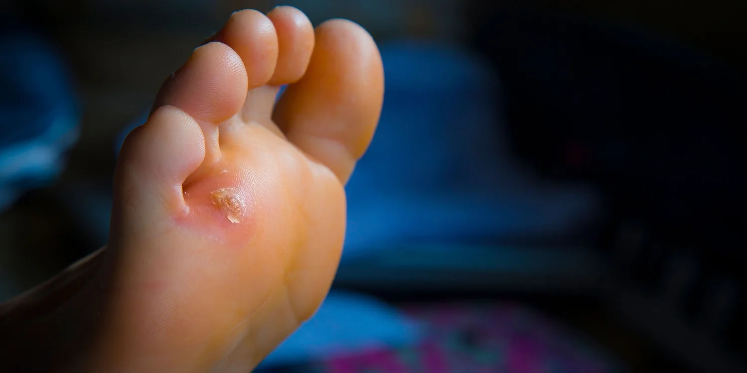 Callus Management: Why It's Crucial for Diabetic Foot Health — Tea ...