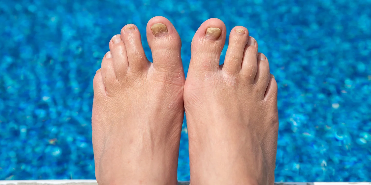 Understanding Toenail Fungus: What Toenail Fungus Looks Like? — Tea ...