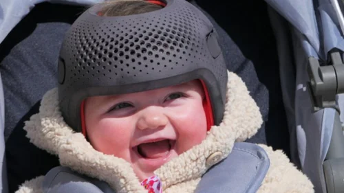 Plagiocephaly & Helmet Therapy: Understanding the Basics — Dr ...
