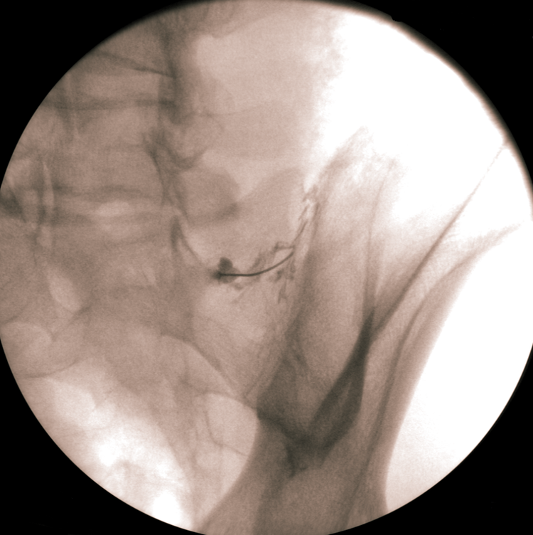 Procedure Fact Sheets — Metro Pain Group