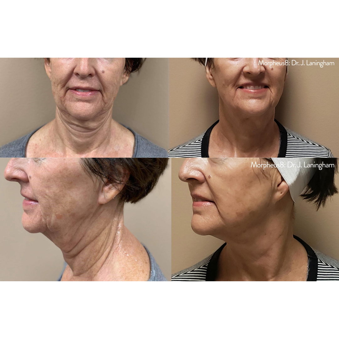 Skin Tightening — BODY BY BARKER