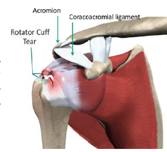 Why does the rotator cuff tear? — Khalid Mohammed Orthopaedic Surgeon