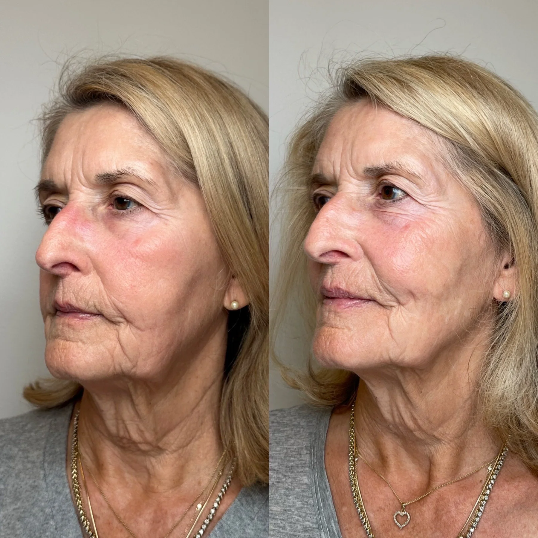 Biostimulators — Medspa Downtown