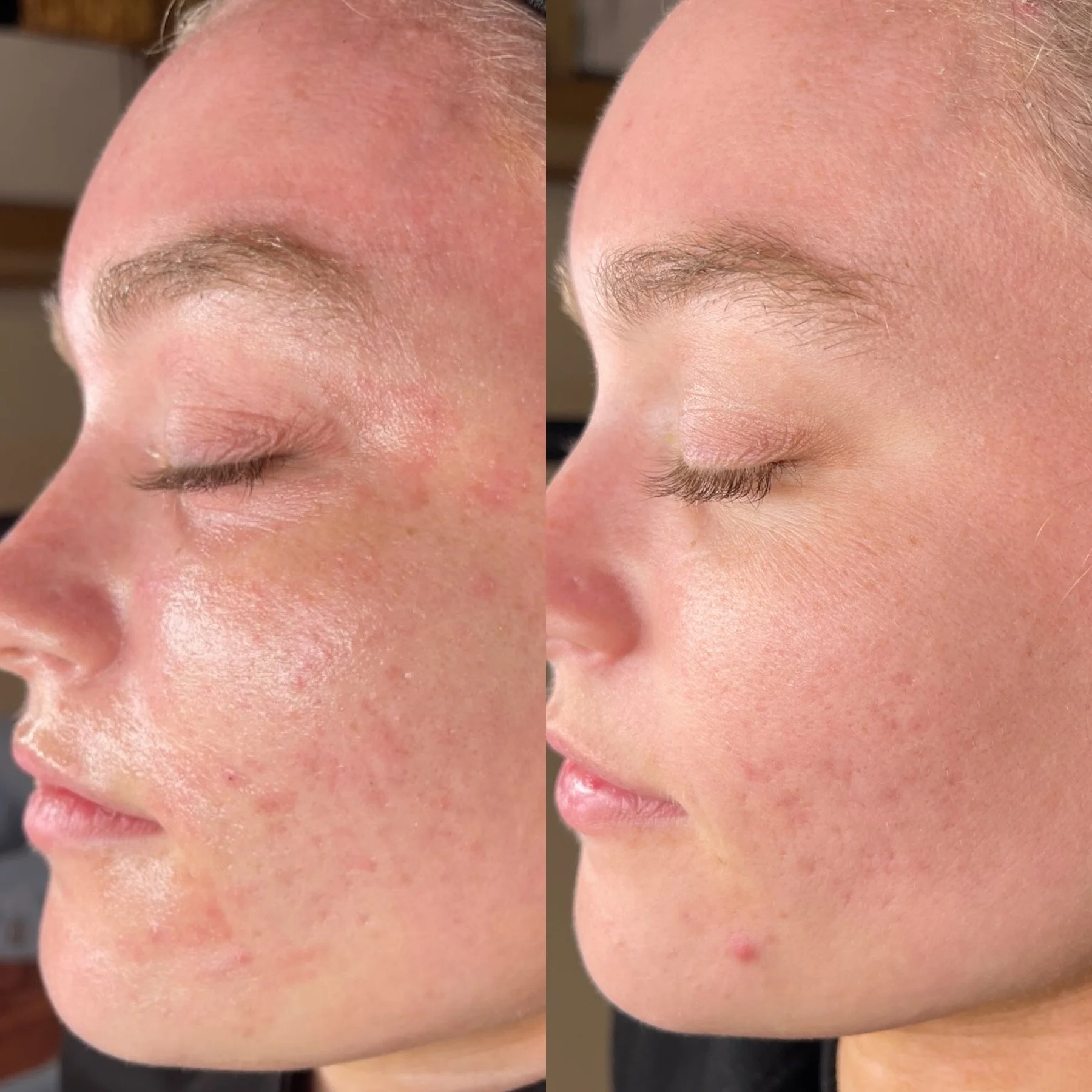 Micro Needling Medspa Downtown