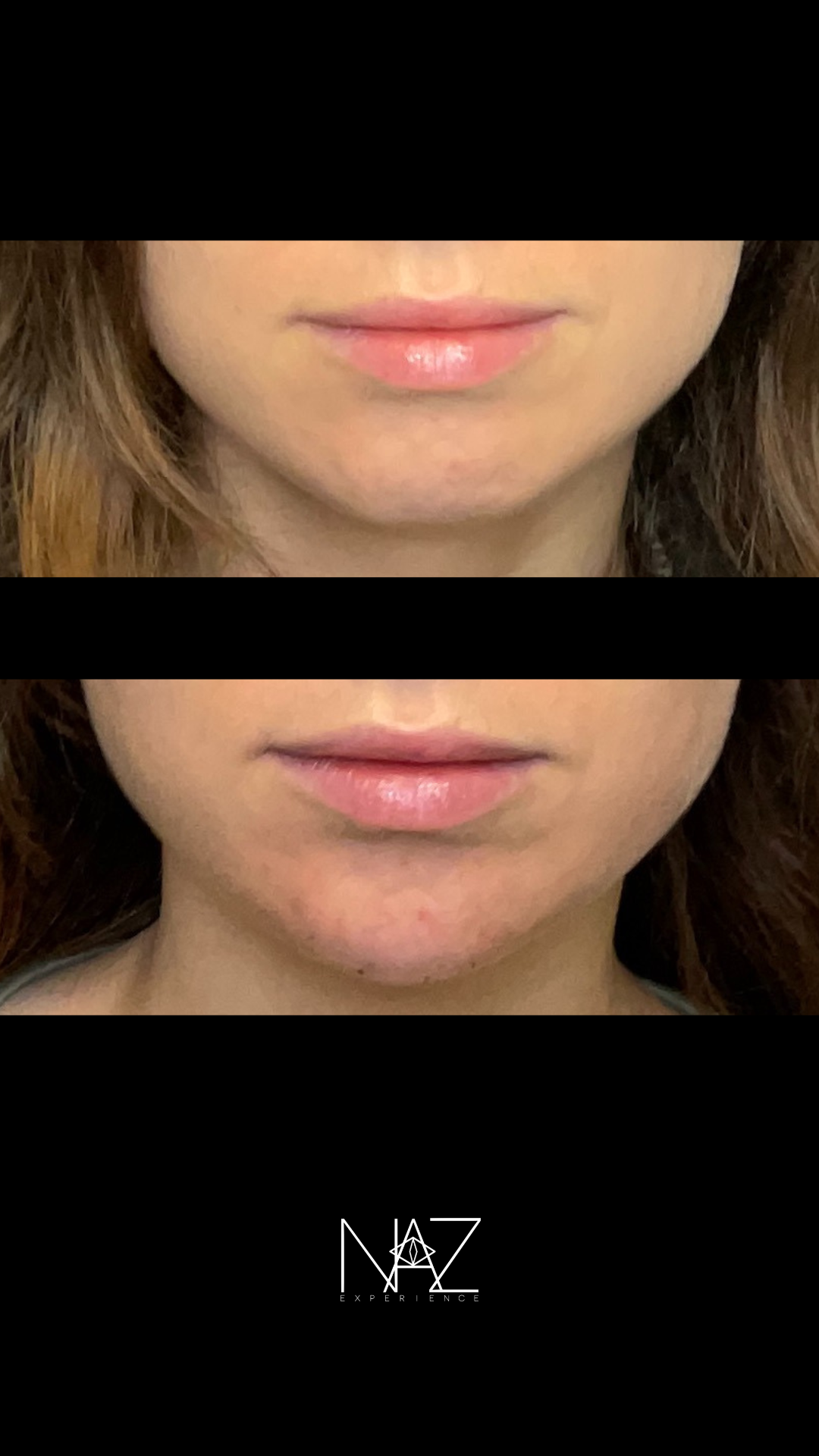 Before & After Gallery | The Naz Experience | Dr. Maryam Nazemzadeh | Cosmetic Surgery + Injectables