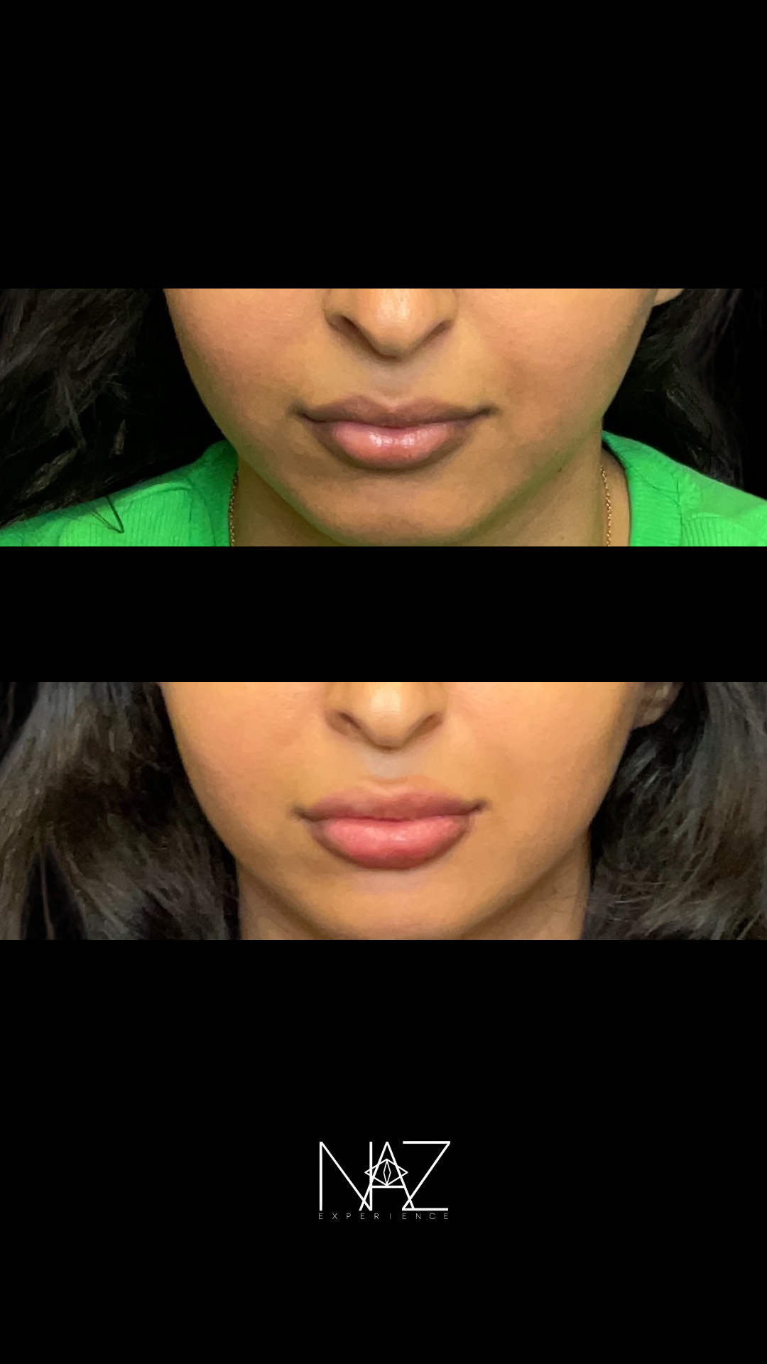 Before & After Gallery | The Naz Experience | Dr. Maryam Nazemzadeh | Cosmetic Surgery + Injectables