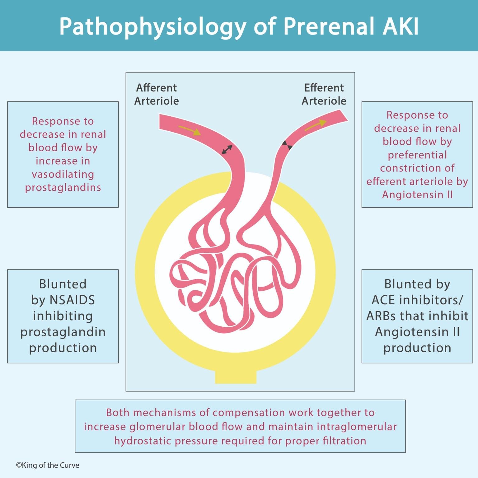 🧠 Pathophysiology of Prerenal Acute Kidney Injury (AKI) — King of the Curve