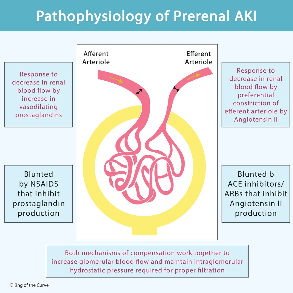 Acute Kidney Injury (AKI): Pathophysiology, Diagnosis, and Management ...