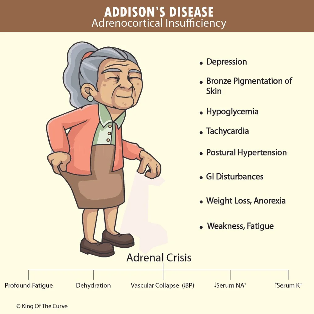 Addison’s Disease NCLEX Guide – Symptoms, Adrenal Crisis & Nursing Care — King of the Curve